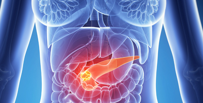 Cancer du pancréas : causes et prévention